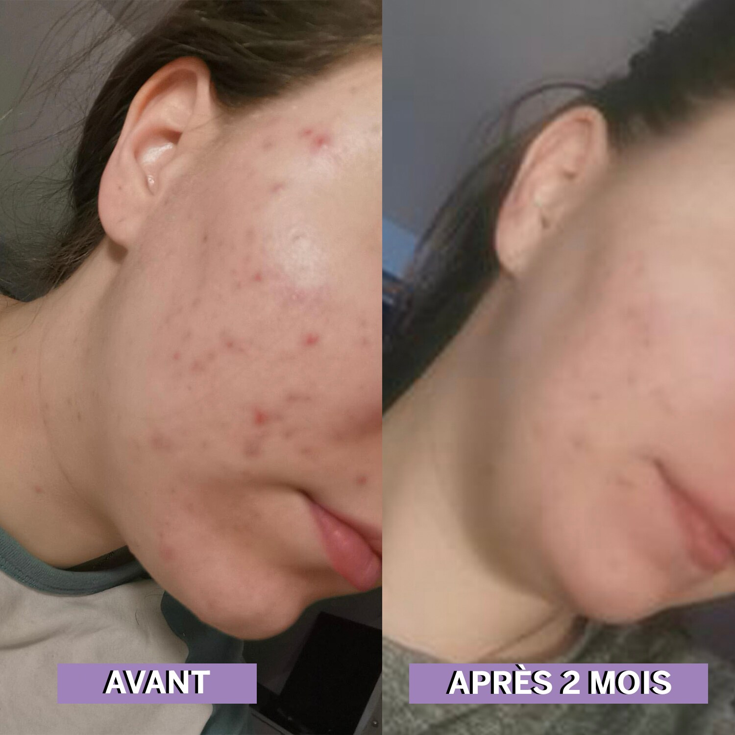 Skin Cleaner Gélules Complément Alimentaire Peau De Birdie ≡ Sephora