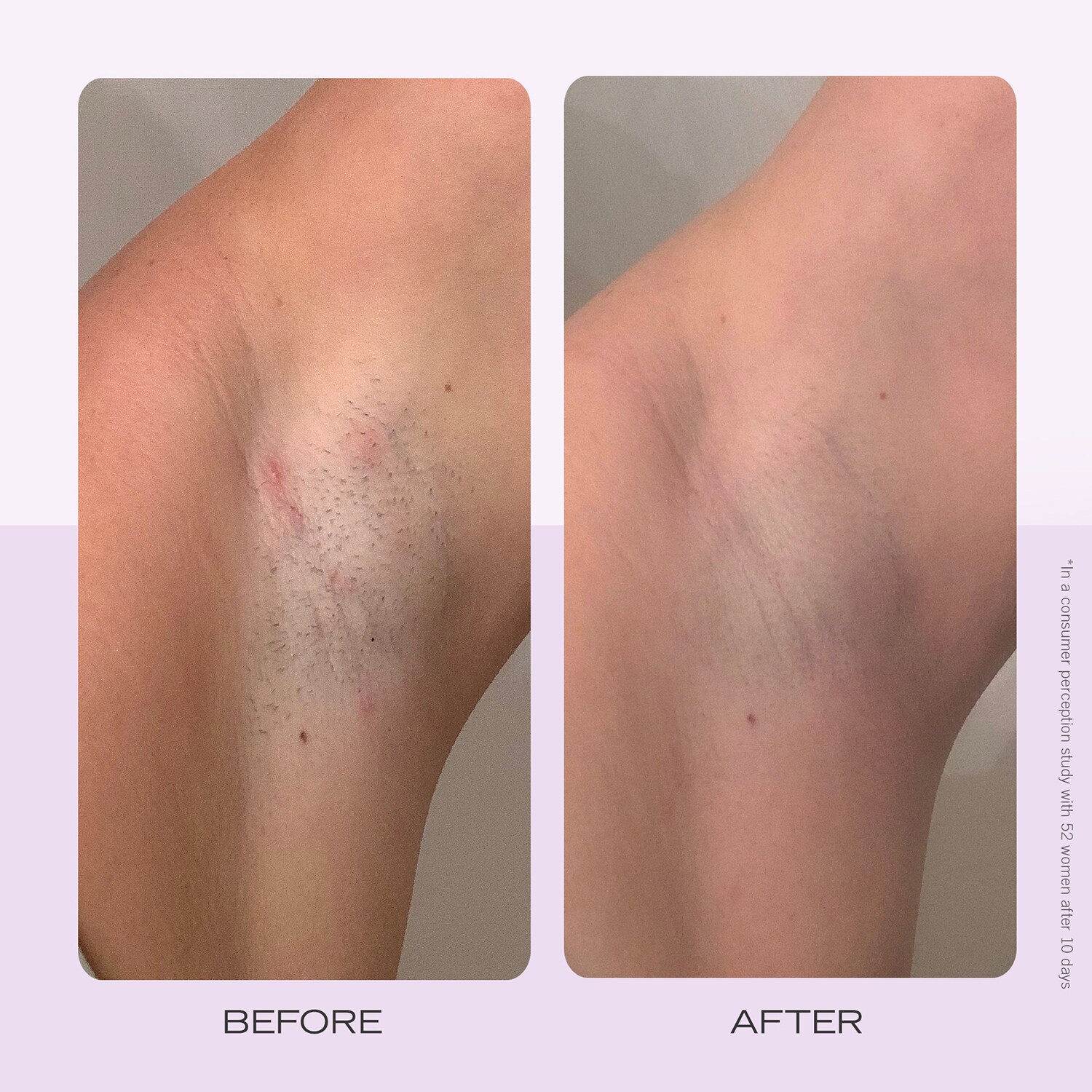 Ingrown Hair Pads - Disques compostables pour poils incarnés x60 de ...